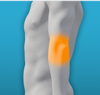 Osteoarthritis of the elbow - msk