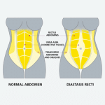 Your stomach muscles during pregnancy - My Joint Health Hub
